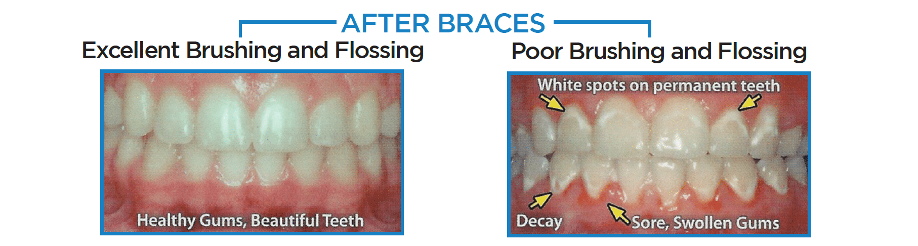 Brushing and Flossing Instructions for Braces at Smile Appeal Orthodontics